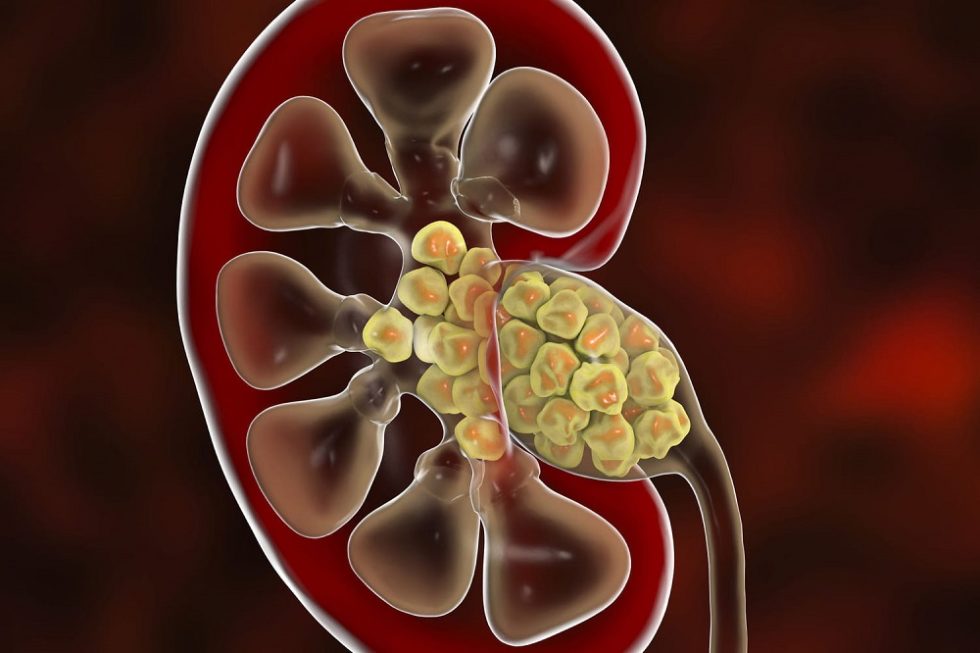 La lithiase rénale : traitement et explication de l’intervention ...